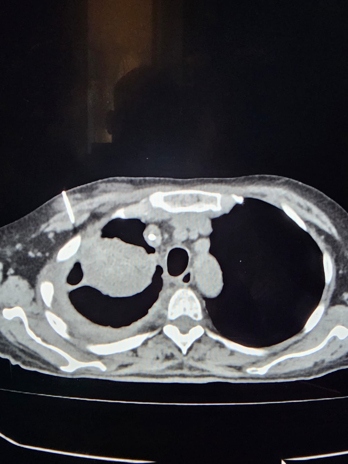 BIOPSIA PULMONAR TOMOGUIADA - Dr. Juan Pablo Bedrán P.